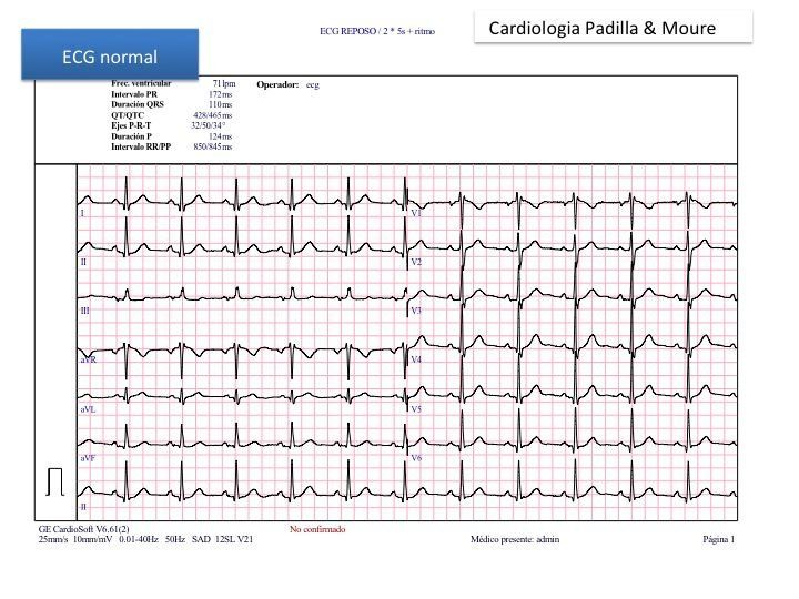 ECG Interpretation: Characteristics Of The Normal ECG, 54% OFF ECG Interpretation: Characteristics Of The Normal ECG, 54% OFF